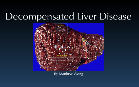 Decompensated Liver Disease by Matthew Wong on Prezi