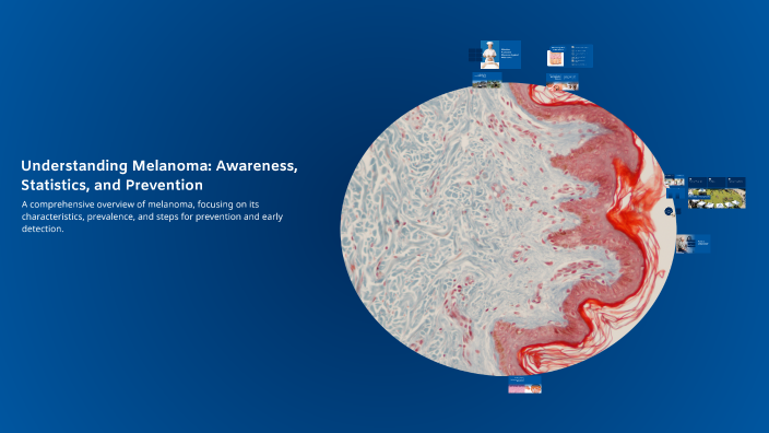 Understanding Melanoma: Awareness, Statistics, and Prevention by Hugo ...