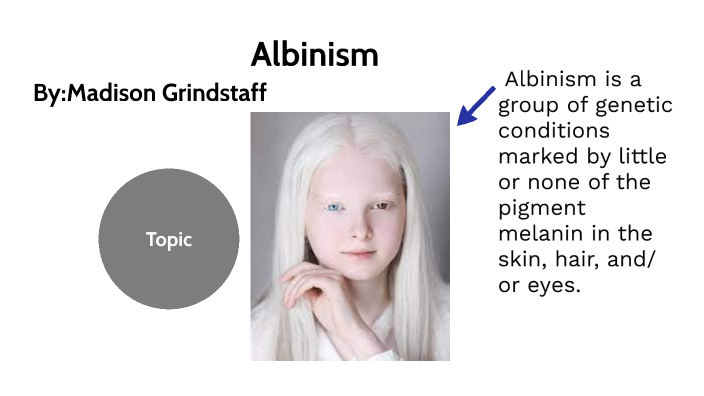 Albinism by Madison Grindstaff on Prezi