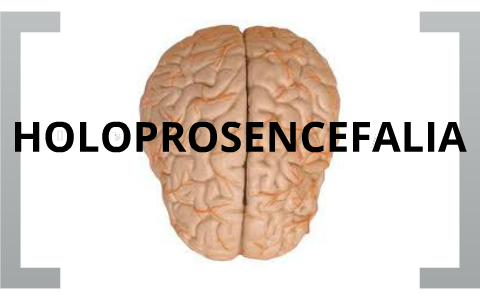 Holoprosencefalia by Thays Gomes on Prezi