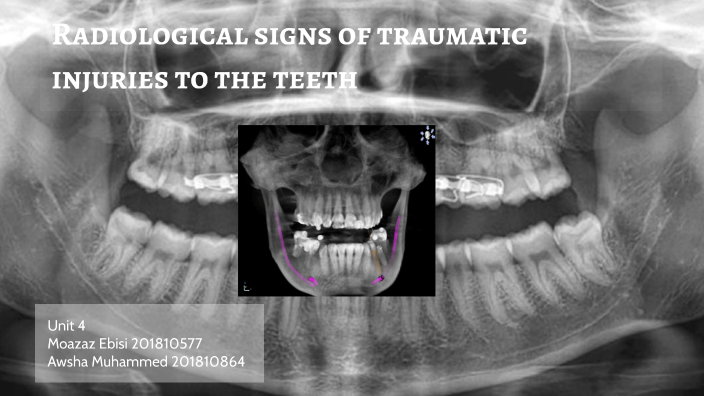 Radiological signs of traumatic injuries to the teeth by Awsha Muhammad ...