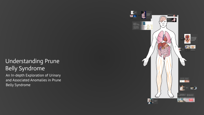 Understanding Prune Belly Syndrome by Dede Achmad Basofi on Prezi