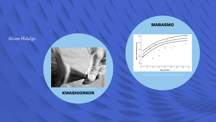 Marasmo y Kwashiorkor by Alison Hidalgo on Prezi
