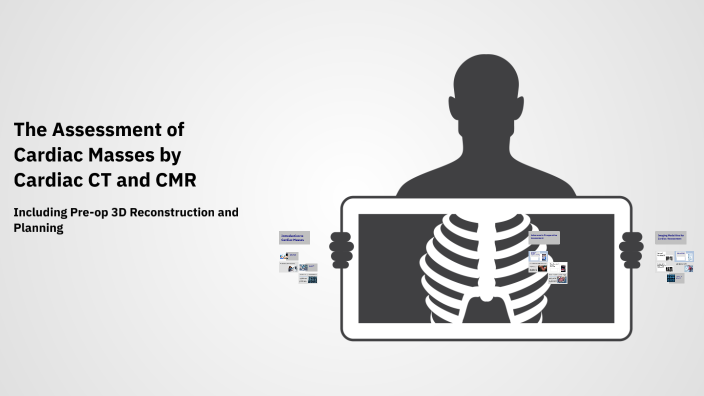 The Assessment of Cardiac Masses by Cardiac CT and CMR by Chong Sheng ...