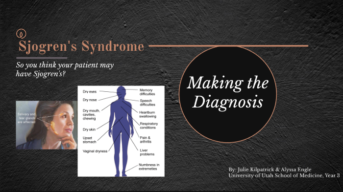 Sjogren's Syndrome by Alyssa Engle on Prezi