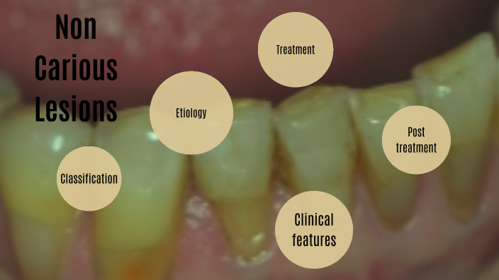 Non carious lesions by yohan chacko on Prezi