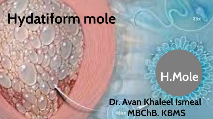 Hydatiform mole by avan khalil on Prezi