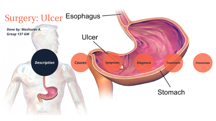 Surgery: Ulcer by Rainbow Light on Prezi