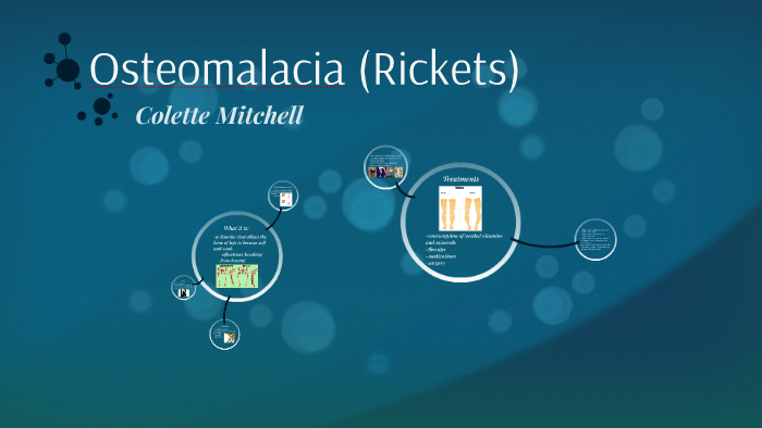Osteomalacia (Rickets) by Colette Mitchell on Prezi