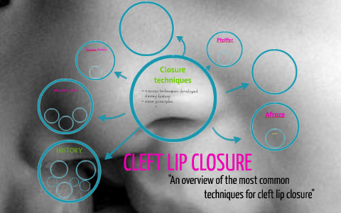 CLEFT LIP CLOSURE by Sien Van Roy on Prezi