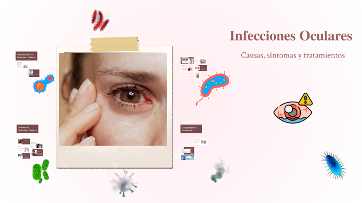 Infecciones Oculares by Tracy Tello on Prezi