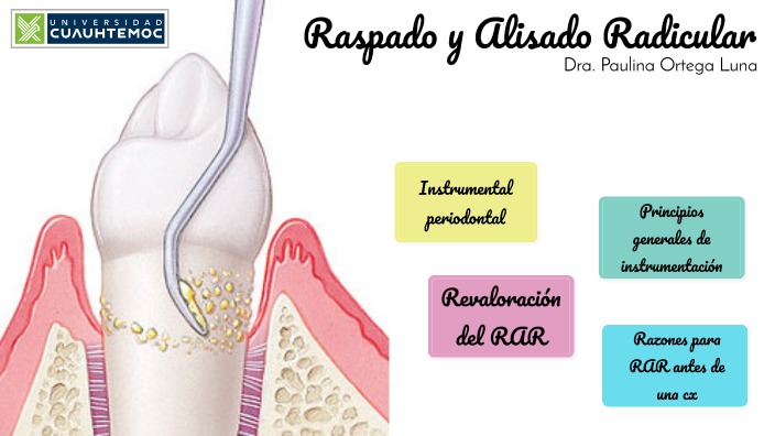 Raspado y Alisado Radicular by PAULINA ORTEGA LUNA on Prezi