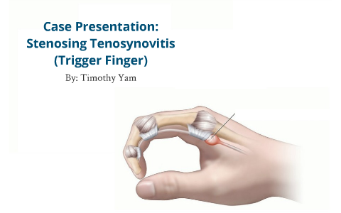 Trigger Finger by Timothy Yam on Prezi