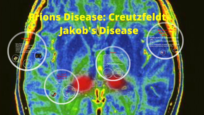 Prions Disease: Creutzfeldt-Jakob's Disease by Belle Eden on Prezi