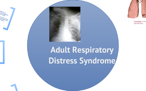 Adult Respiratory Distress Syndrome by Michael Tuggy on Prezi