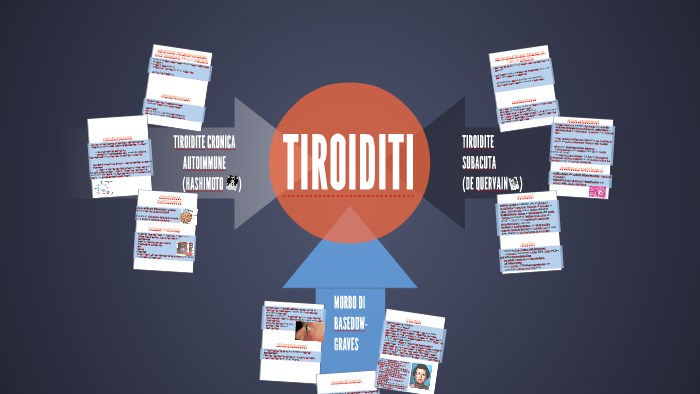 TIROIDITE CRONICA AUTOIMMUNE (HASHIMOTO) by Alessandro Gabriel Truzzi ...