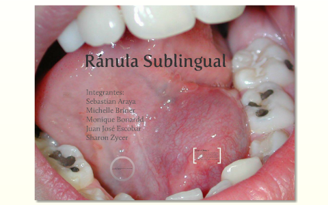 Ránula Sublingual by Benjamin Gracia on Prezi