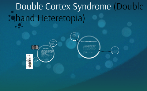 Double Cortex Syndrome (Doble band Heteretopia by Pierina Santa Maria ...