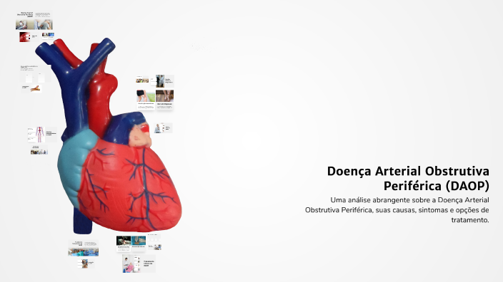 Doença Arterial Obstrutiva Periférica (DAOP) by juliana suguita on Prezi