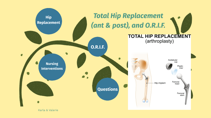 Total Hip Replacement & ORIF by valerie mel on Prezi
