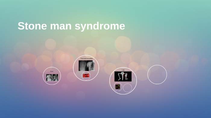 Stone man syndrome by jesus delgado on Prezi