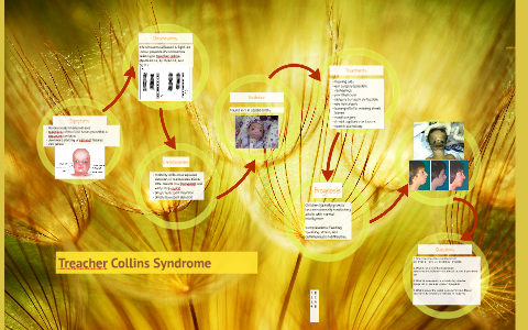 Treacher Collins Syndrome by Devon Pratt