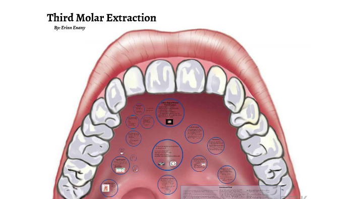 Third Molar Extraction by Erinn Enany on Prezi