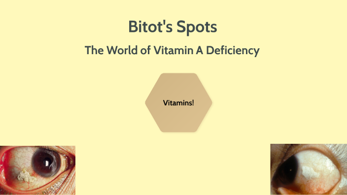 Bitot's Spots - Vitamin A Deficiency by Ethan Lenz on Prezi