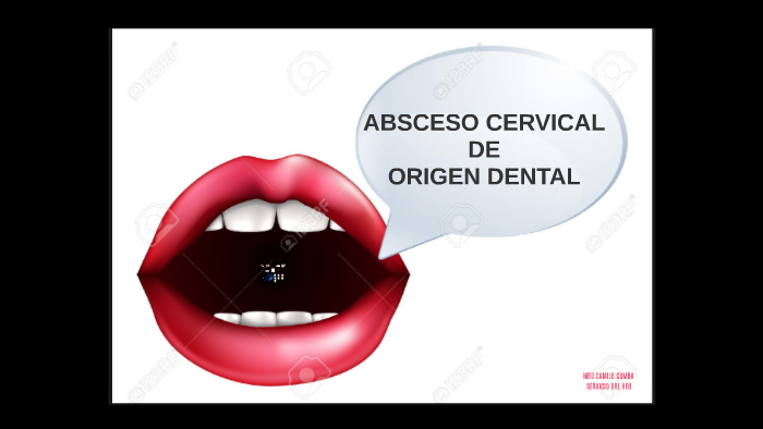 ABSCESO CERVICAL by Camilo Comba on Prezi