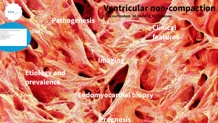 Ventricular non-compaction by Domenico Ciancone on Prezi