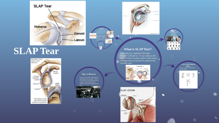 SLAP Tear by Leticia Uck