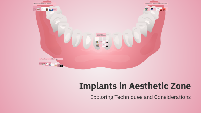 Implants in Aesthetic Zone by Abdullah Hussein on Prezi