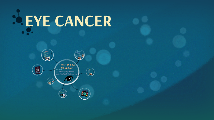 EYE CANCER ppt by Tanjuma Haque on Prezi
