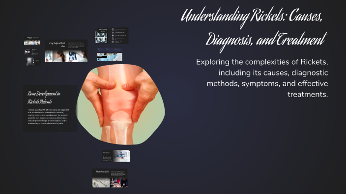 Understanding Rickets: Causes, Diagnosis, and Treatment by Joel Rembaum ...