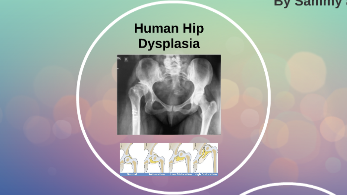 Hip Dysplasia by Sammy Leach