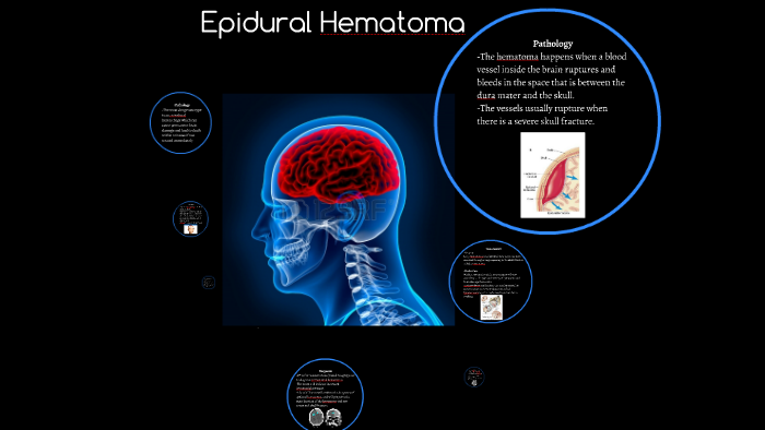 An epidural hematoma is basically bleeding inside the brain. by Maria ...