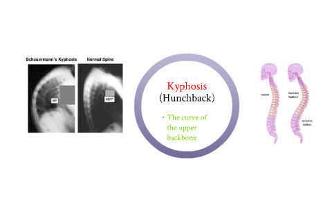 Skeletal Disorder:Kyphosis by Casey R. on Prezi