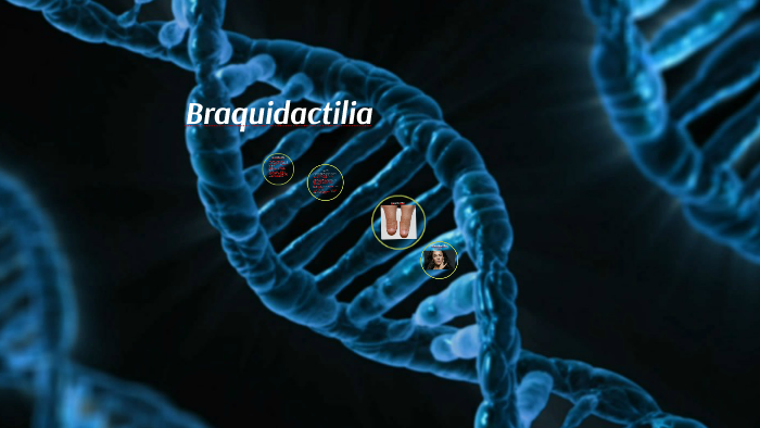 Braquidactilia by on Prezi