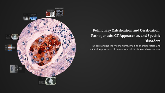 Pulmonary Calcification and Ossification: Pathogenesis, CT Appearance ...