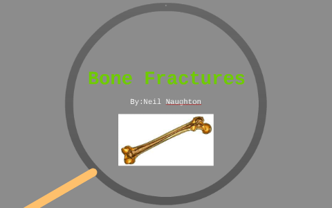 Broken Bones by Neil Naughton on Prezi