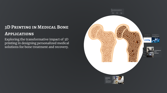 3D Printing in Medical Bone Applications by Antonio Cr on Prezi