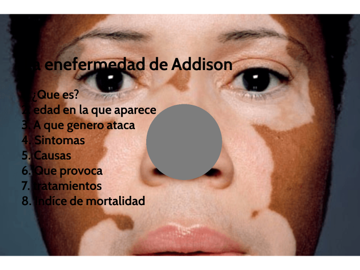 La enfermedad de Addison by Emmanuel david Guerrero brand on Prezi