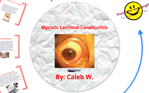 Mycotic Lacrimal Canaliculitis by Will Cal w on Prezi