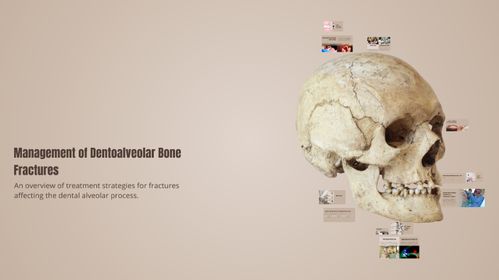 Management of Dentoalveolar Bone Fractures by Mohammed Almutairi on Prezi