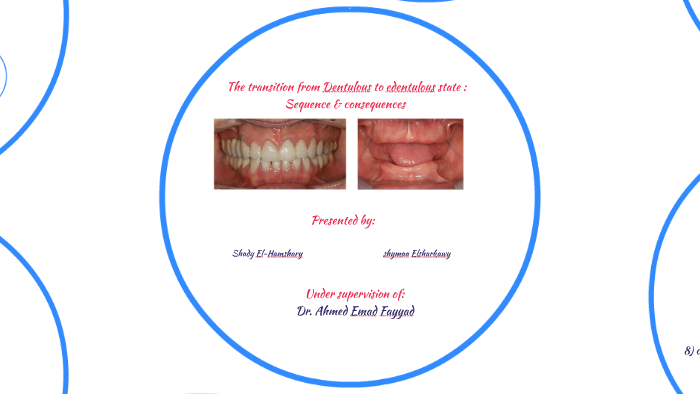 The transition from Dentulous to edentulous state : Seq by Shymaa ...