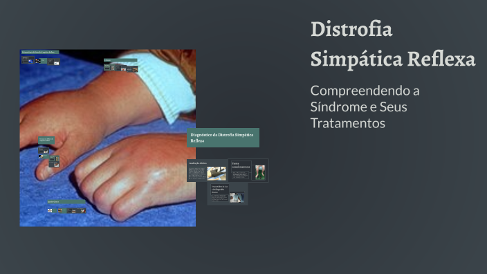 Distrofia Simpática Reflexa by João Gabriel dos Santos on Prezi