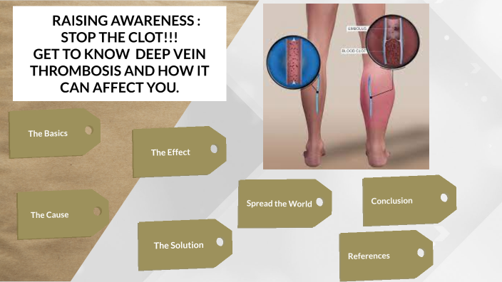Deep Vein Thrombosis (DVT) : An Overview by Toni Williams on Prezi
