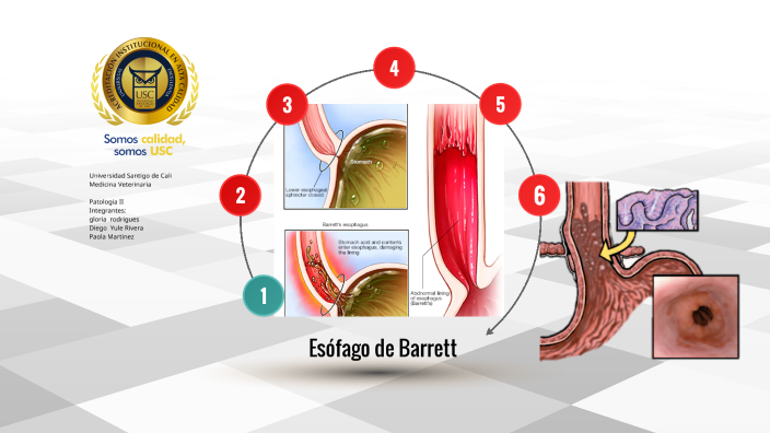 Esófago de barrett by Diego Rivera on Prezi