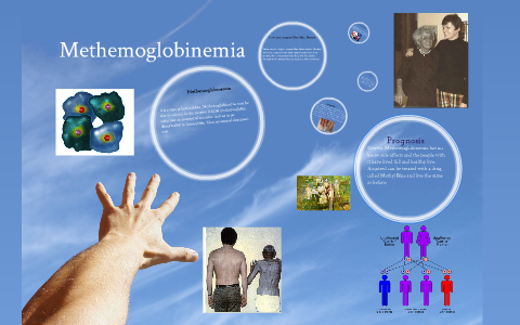 Methemoglobinemia by Meg East