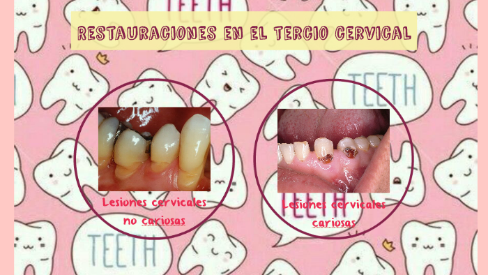 Restauraciones en el tercio cervical by camila prada on Prezi